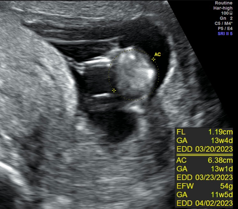 11w5d的超音波｜懷孕大小事板｜媽咪愛